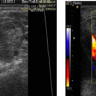 Heterogeneous Goitre With Increased Circulatory Speeds On Doppler In Download Scientific