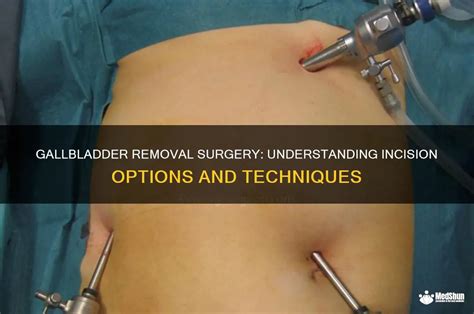 Gallbladder Removal Surgery Understanding Incision Options And