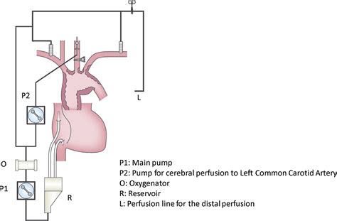 Impact Of Isolated Cerebral Perfusion Technique For Aortic Arch Impact Of Isolated Cerebral Perfusion Technique For Aortic Arch