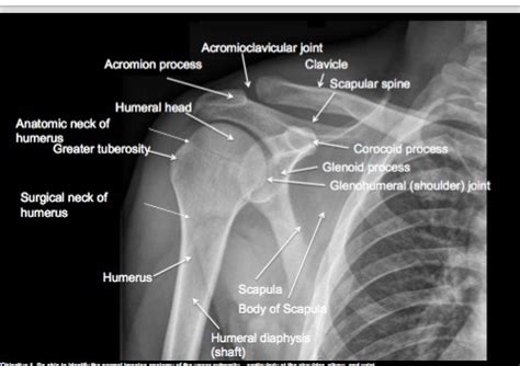Shoulder X Ray Anatomy Rachel Rubin Sarganis The First X Ray Shows A