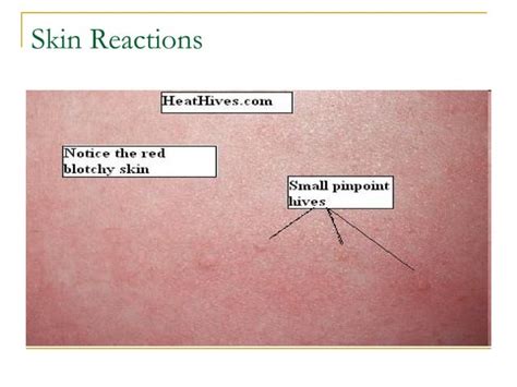Anaphylaxis Ppt
