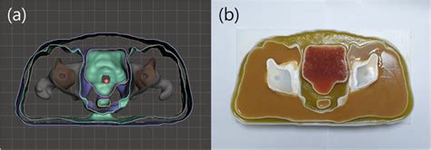 Development Of An Anthropomorphic Multimodality Pelvic Phantom For