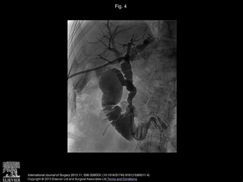 Percutaneous Transhepatic Endoscopic Holmium Laser Lithotripsy For