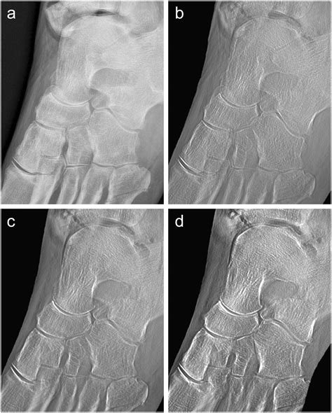 Tomosynthesis Of The Appendicular Skeleton On A Twin Robotic X Ray System A Cadaveric Fracture