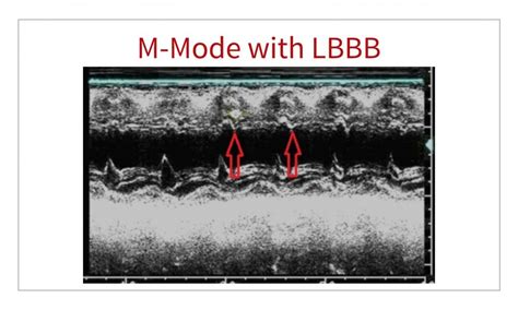 Bundle Branch Block Measurement