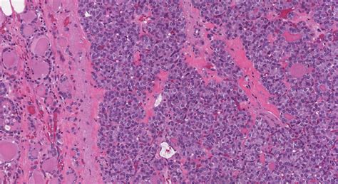 Non Invasive Follicular Thyroid Neoplasm With Papillary Like Nuclear Features Atlas Of Pathology