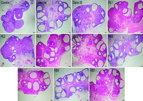 Polycystic Ovary Histology