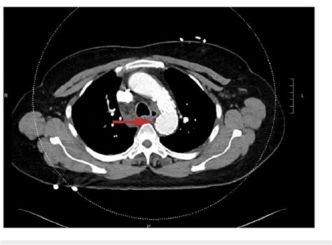 The Chest Ct Angiography Image Demonstrates The Aortic Arch Subsequent Download Scientific