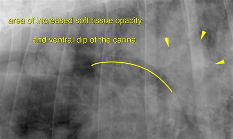Rad Severe Nodular Interstitial Pattern With Alveolar Infiltrate Likely Histocytic Sarcoma