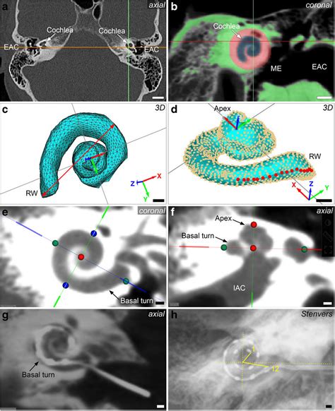 Cochlear Duct Length Cdl Measurement Approaches A Axial View Of A Download Scientific