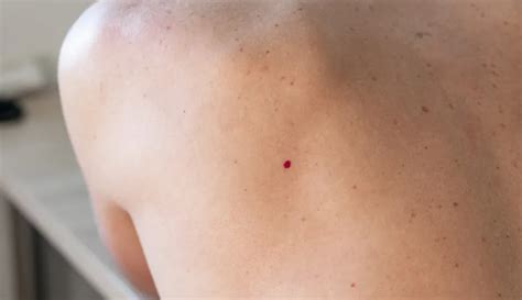 Melanoma Red Dots On Skin