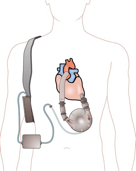 Lvad Insertion Amarillo Heart Institute