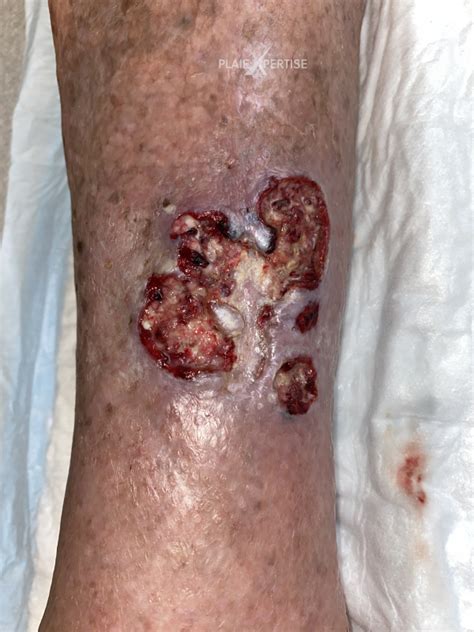 Pyoderma Gangrenosum — Plaiexpertise Base De Connaissances
