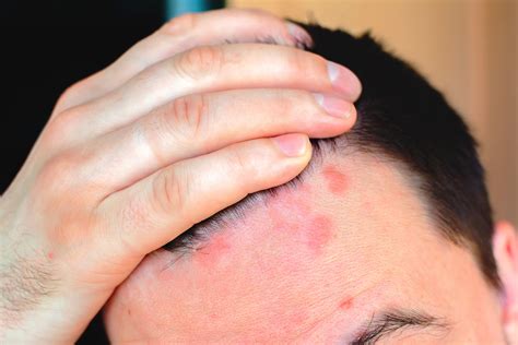 What Causes Scalp Yeast Infection Ds Healthcare Group