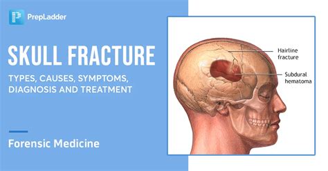 Skull Fracture Types Causes Symptoms Diagnosis Andtreatment