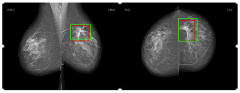 Evaluating Recalibrating AI Models For Breast Cancer Diagnosis In A New Context Insights From