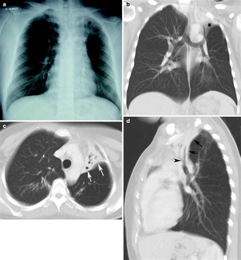 Atelectasis Springerlink