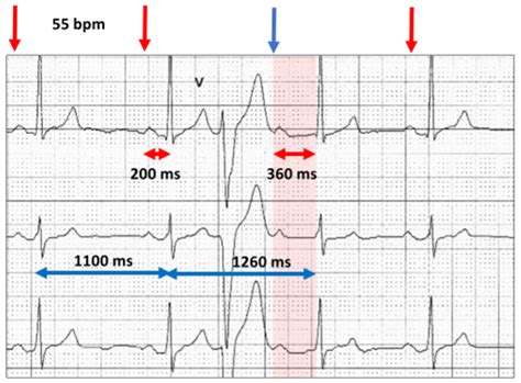 Interpolated Ventricular Ectopy