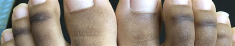 Hyperpigmentation On Toes Rskincareaddiction