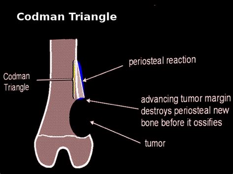 Osteosarcoma Codmans Triangle