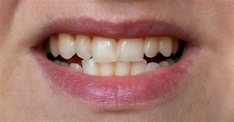 What Colour Of Your Teeth Really Means From Liver Disease To