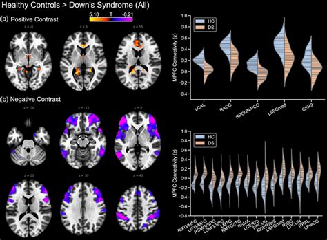 Differences In Default Mode Network Connectivity Mpfc Seed Between