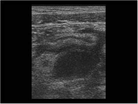 Abdomen And Retroperitoneum 1 5 Appendix Case 1 5 6 Post Appendectomy Ultrasound Cases