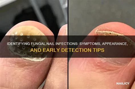 Identifying Fungal Nail Infections Symptoms Appearance And Early