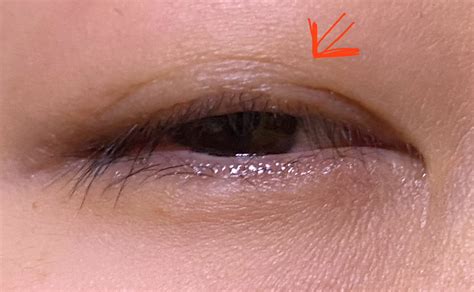 의사에게 물어보세요 2015년에 매몰 강남언니 1등 성형수술and피부시술 정보앱