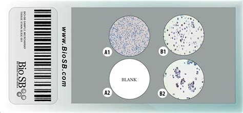Cancer Human Cell Line Microarrays