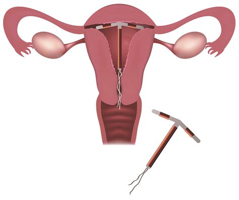 Intrauterine Device