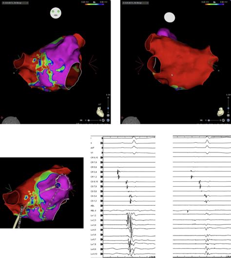 Left Atrial Appendage Isolation Left Atrial Appendage Isolation In A Download Scientific