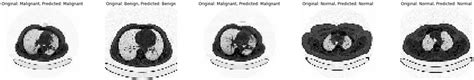 Lung Cancer Detection Using Convolutional Neural Network On The Cainvas