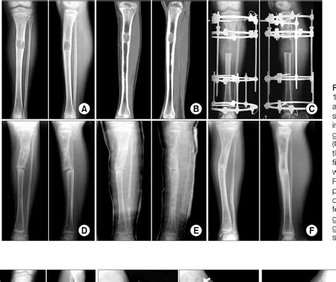 Figure 1 From Treatment Of Bone Loss Using Ilizarov Fixation After Resection Of Benign Tumor In