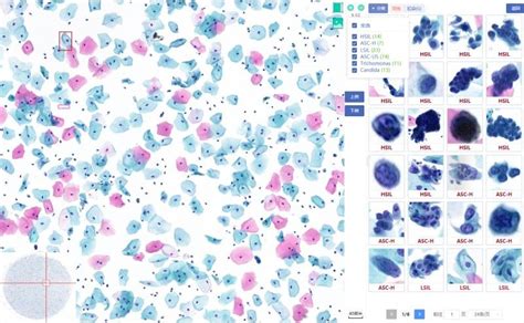 Advantages Of Liquid Based Cytology Over Traditional Pap Smear In