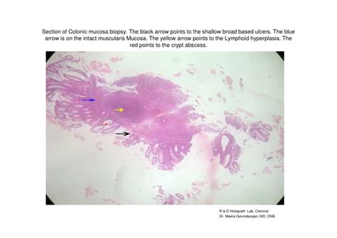 Ppt Section Of Colonic Mucosa Biopsy The Black Arrow Points To The