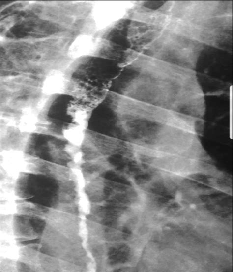 Caustic Esophagitis At Don Pursel Blog