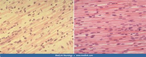 X Linked Myotubular Myopathy Medlink Neurology