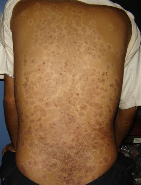 The Rash At Patient S Back Download Scientific Diagram