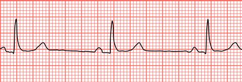 Sick Sinus Syndrome Geeky Medics