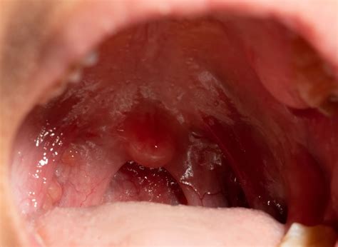 Faringite Causas Sintomas Tratamento