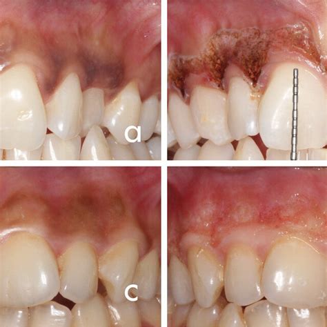 A Preoperative Intraoral Buccal View Of The Patient With Gingival