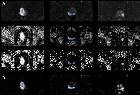 Comparison Of Synthesized And Acquired High B Value Diffusion Weighted Mri For Detection Of