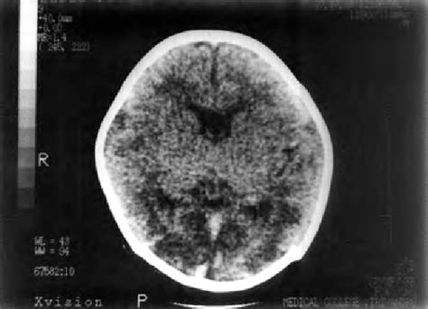 Figure 1 From Ct Imaging Of Neonatal Hypoglycemia Semantic Scholar
