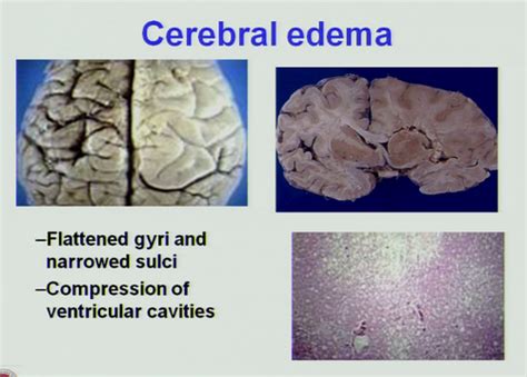 Hyponatremia Flashcards Quizlet