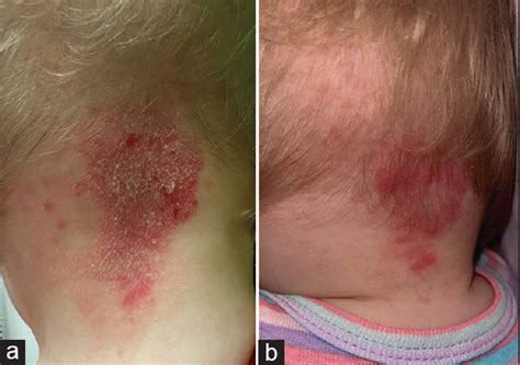 Meyerson Phenomenon In A Nevus Simplex Pmc