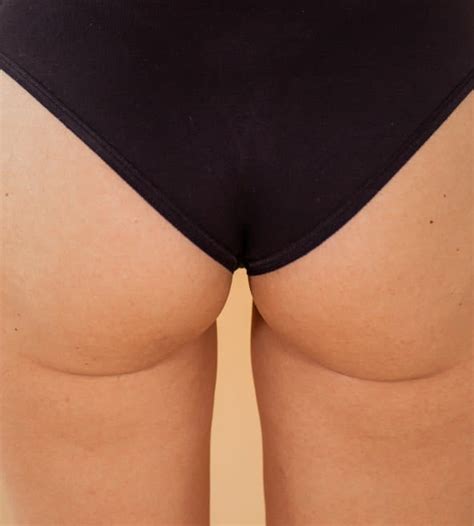 Buttocks Reduction Solutions Overview Cost Recovery Before And After