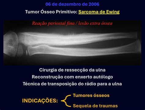 Ewing Sarcoma Images