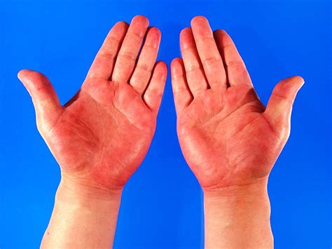 Erythema Hands
