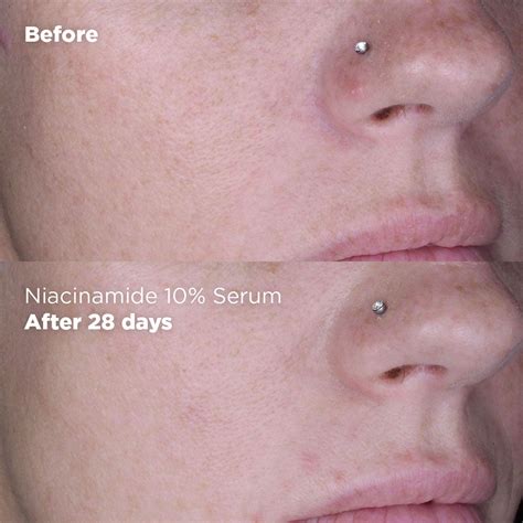 Niacinamide 10 Serum Skin Republic Skin Republic South Africa